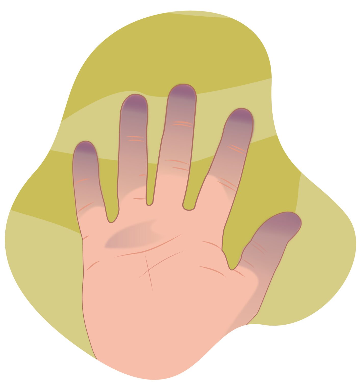 Enfermedad de Raynaud | Síntomas, tratamiento y diagnóstico | IMSKE