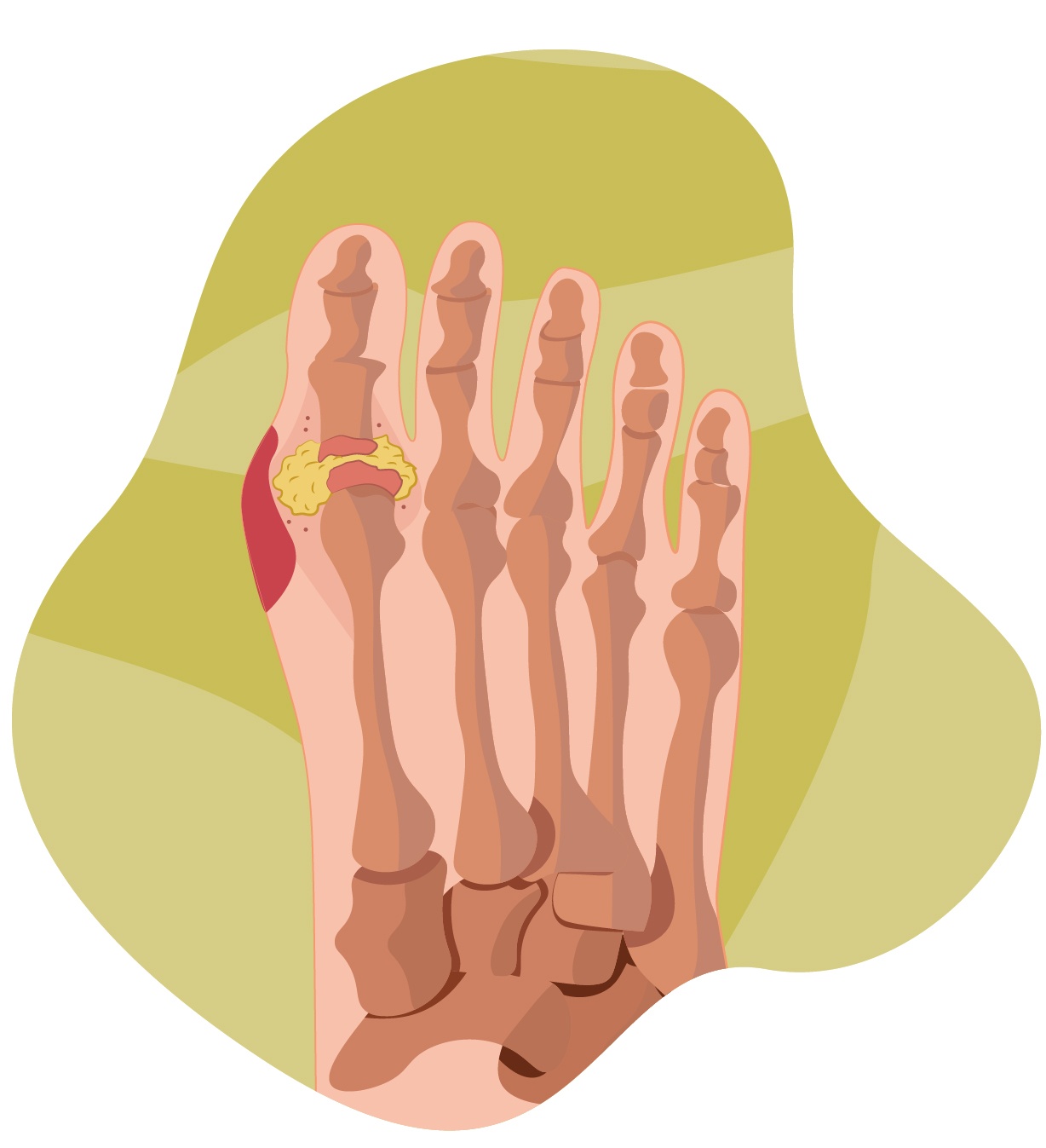 Gota | Síntomas, tratamiento y diagnóstico | IMSKE