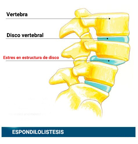 Espondilolistesis | Hospital IMSKE Valencia | Columna y Espalda